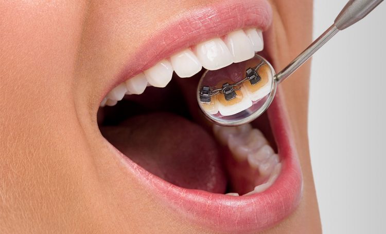 Brackets Linguales - Ortodoncias